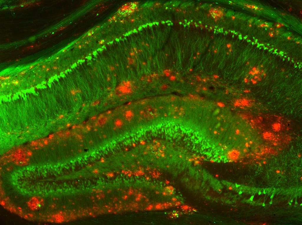 Women’s Omega-3 Depletion Linked to Higher Alzheimer’s Ri ...